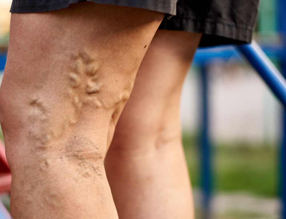 Do This Immediately For A Popped Vein - Vein Institute Of Pinellas