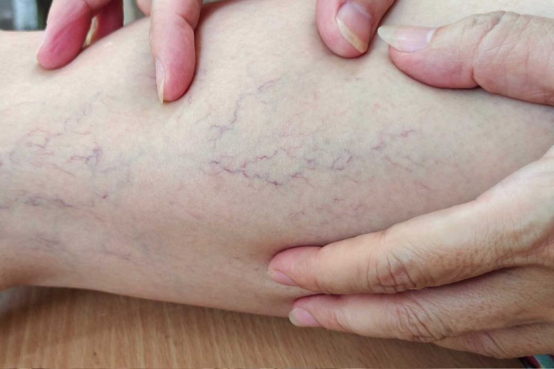 Why Veins Appear Blue | Vein Institute Of Pinellas